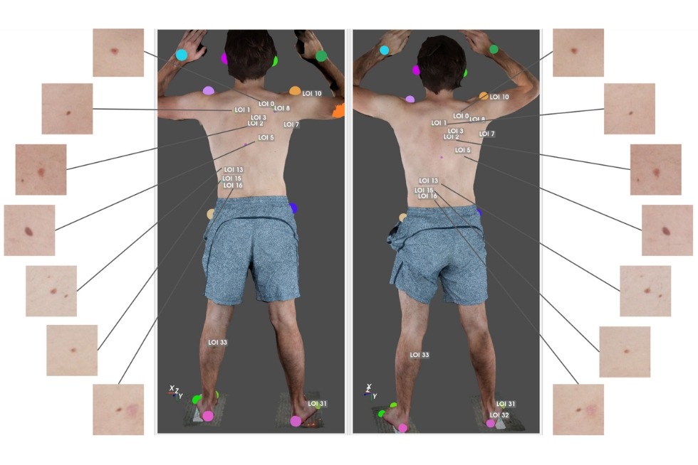 Using computer vision to catch early-stage skin cancer - Department of ...
