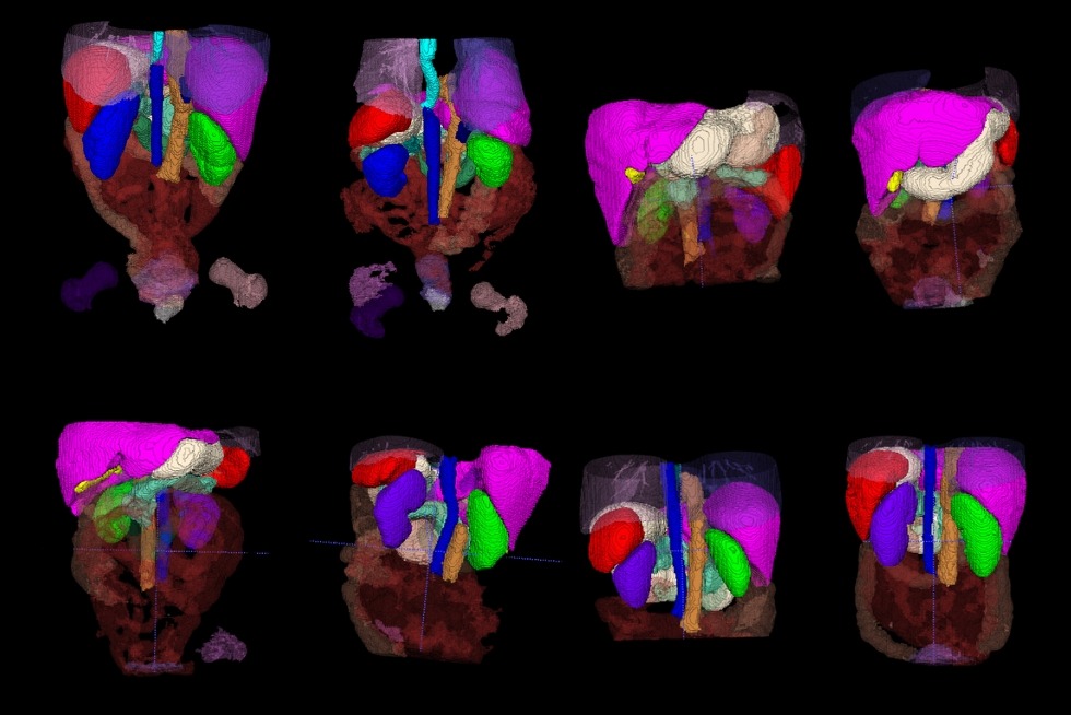AI and radiologists unite to map the abdomen - Department of Computer ...
